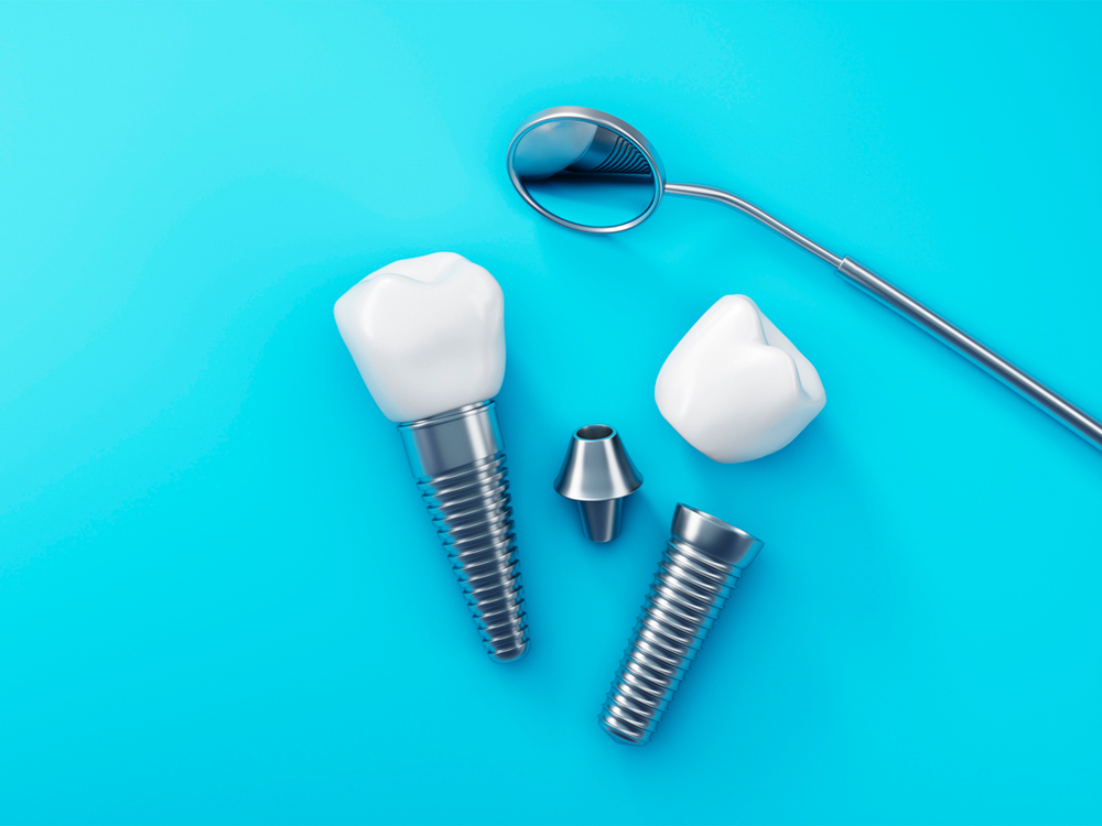 What Are Dental Implants? - High Point Dental Partners - High Point, NC